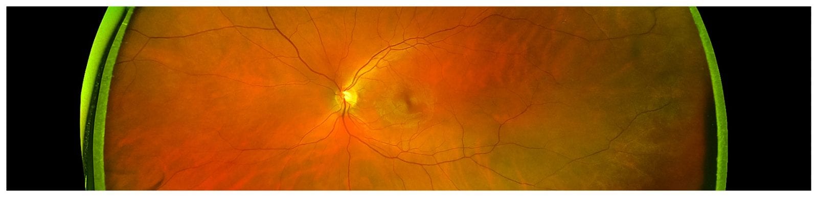 Retina - UCHealth