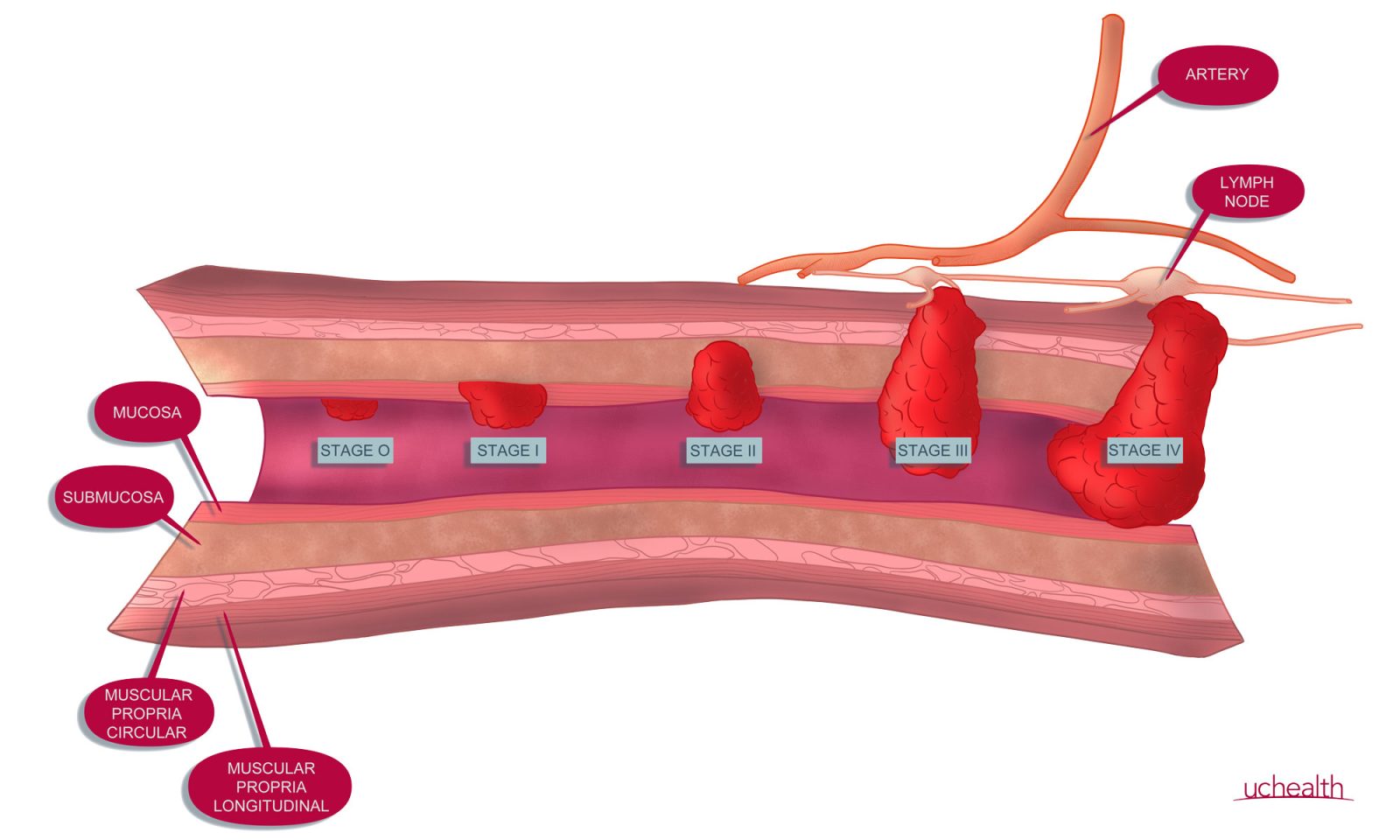 Colon cancer diagnosis and treatment at UCHealth | Colorado