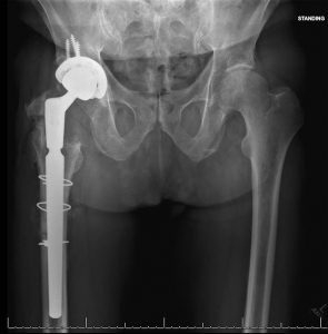 With hip revision surgery, second time’s a charm. - UCHealth Today