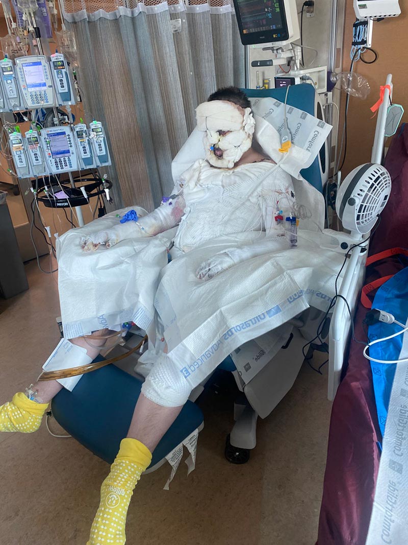 'Spray-on skin' helps young man regenerate skin tissue - UCHealth Today