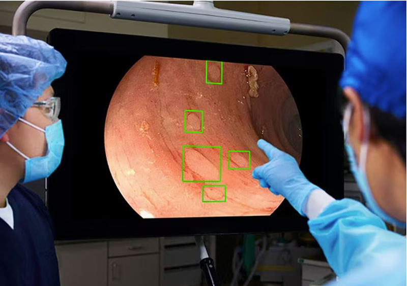 GI Genius' AI assists in colonoscopies - UCHealth Today
